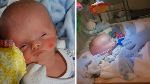 Baby boy born with severely swollen head due to rare condition is ...
